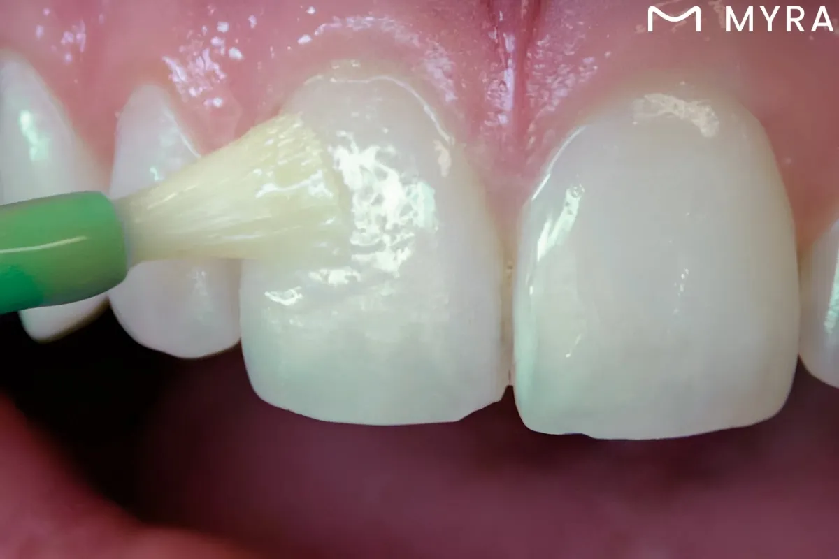 Çocuklarda Flor Uygulamaları: Flor Uygulamalarının Yararları | Myra Dental