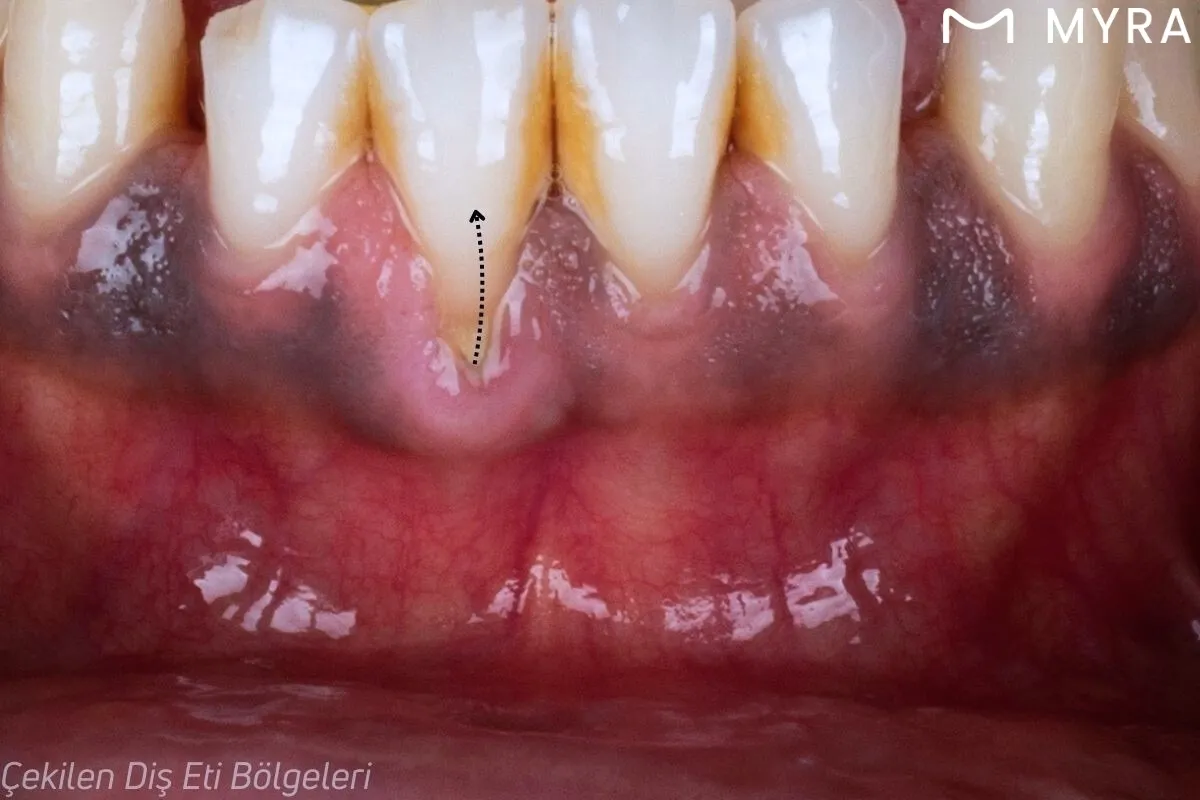 Diş Eti Grefti Tedavisi ile Diş Eti Çekilmesine Kesin Çözüm | Myra Dental