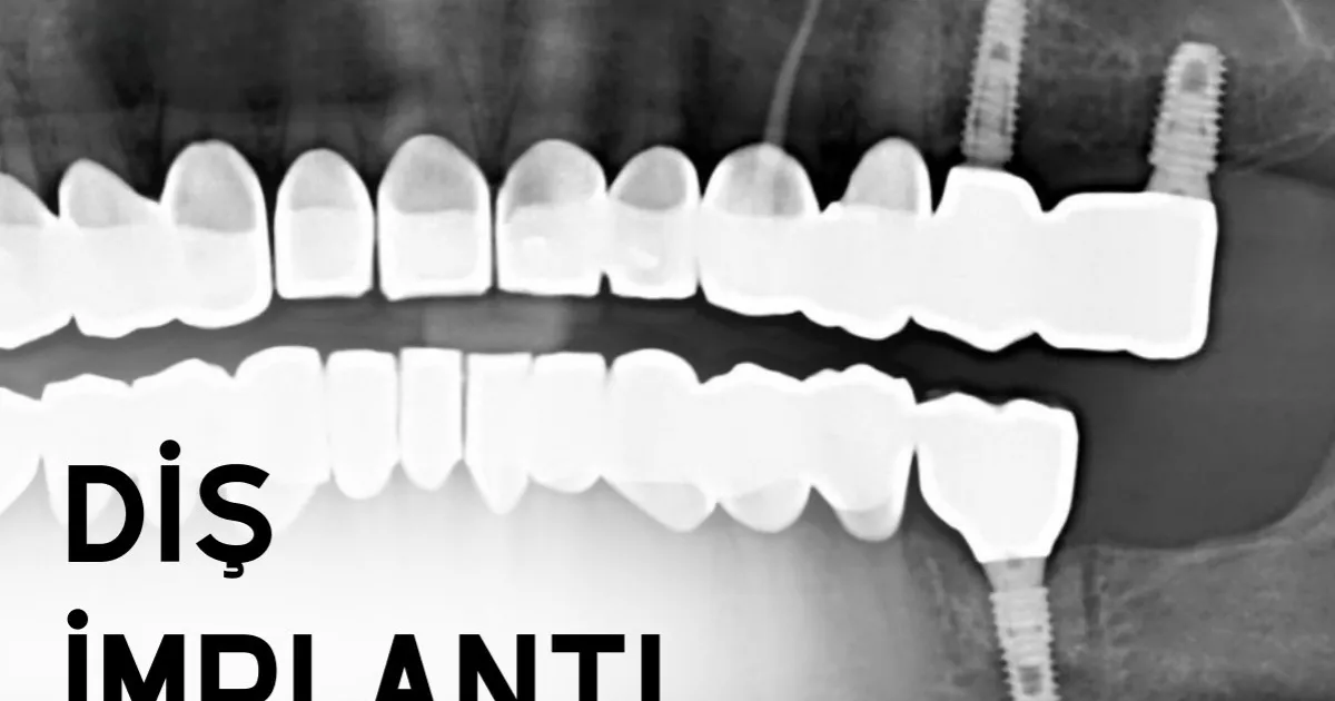 Diş İmplantı Nasıl Yapılır? 6 Adımda İmplant Tedavi Süreci | Myra Dental