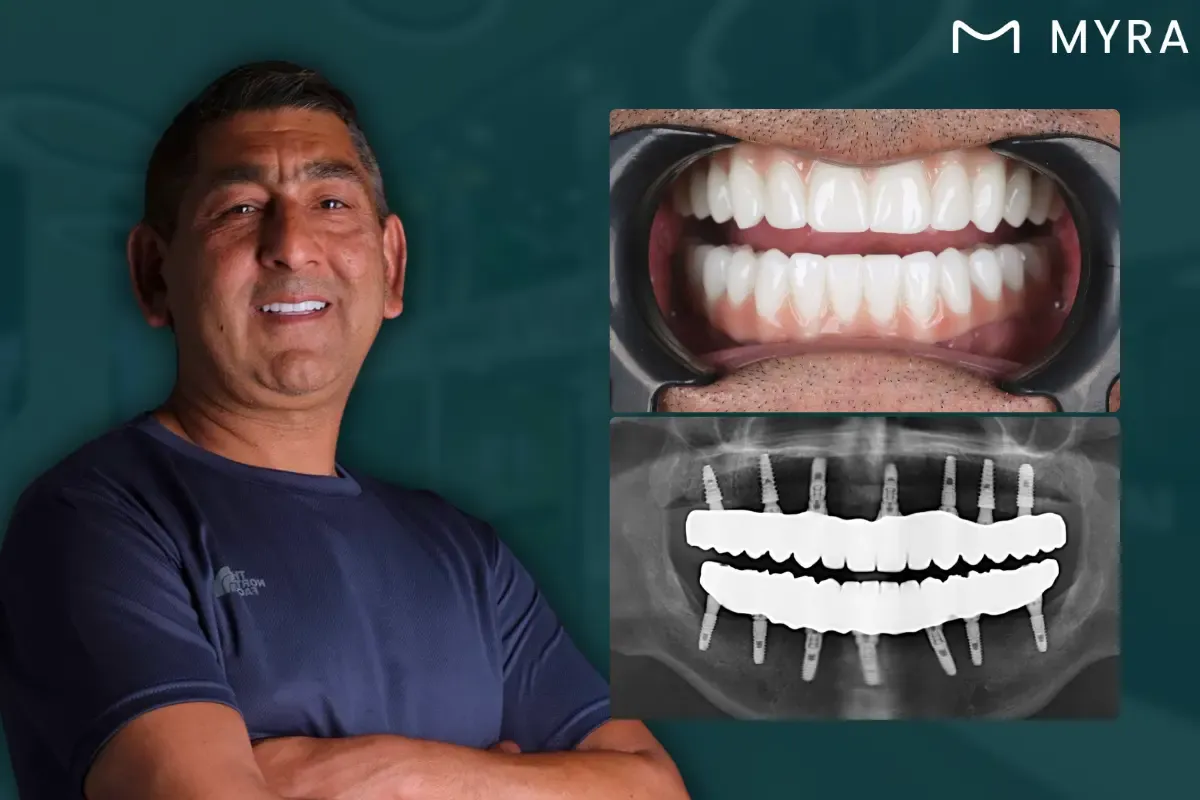 Diş İmplantı Nasıl Yapılır? 6 Adımda İmplant Tedavi Süreci | Myra Dental